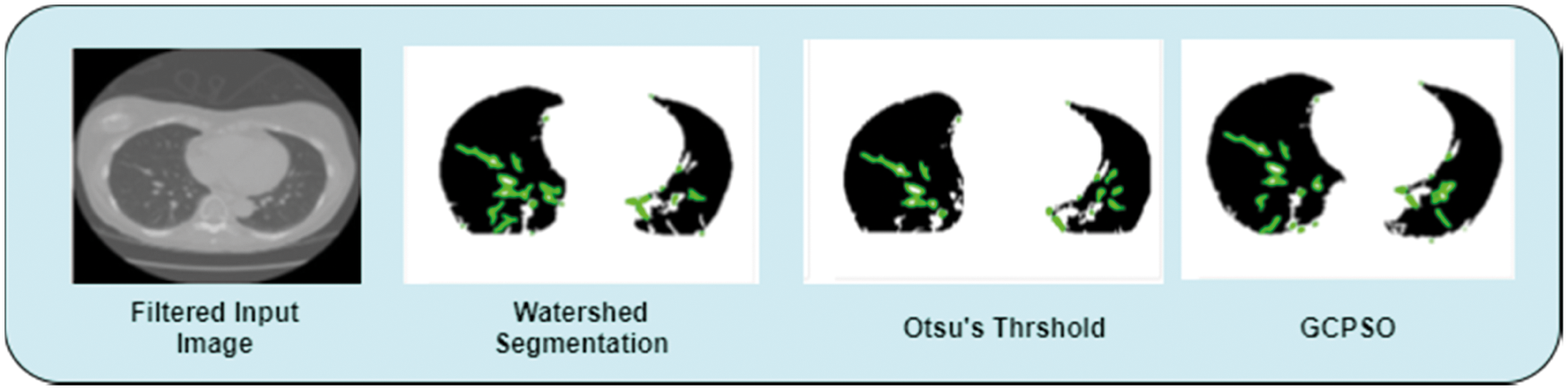 Detection of Lung Tumor Using ASPP-Unet with Whale Optimization Algorithm